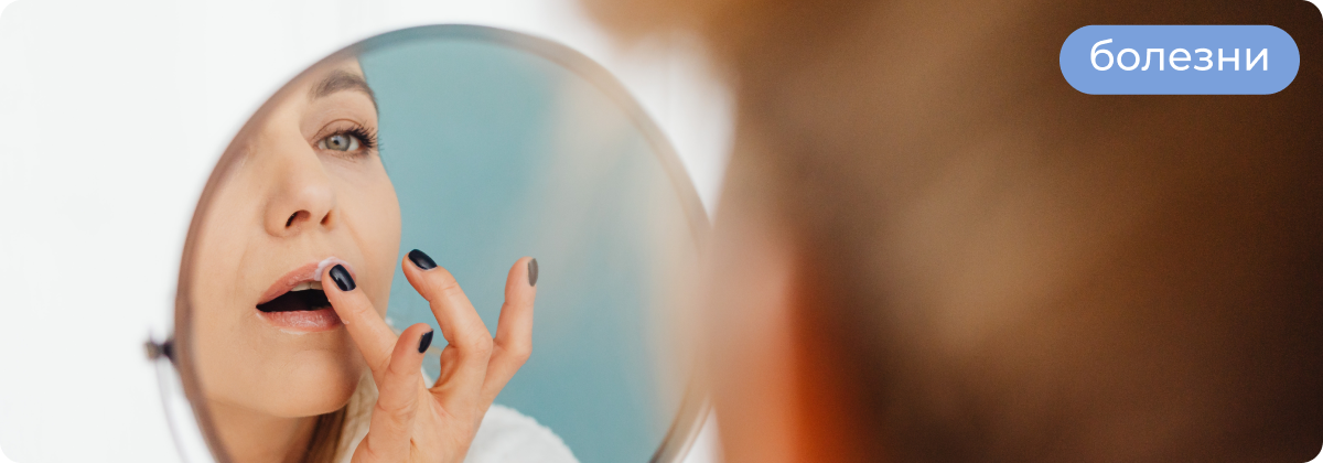 Герпес: причины появления, симптомы и лечение вируса